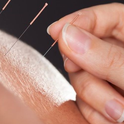 How much does acupuncture cost in Australia? | NaturalTherapyPages.com.au